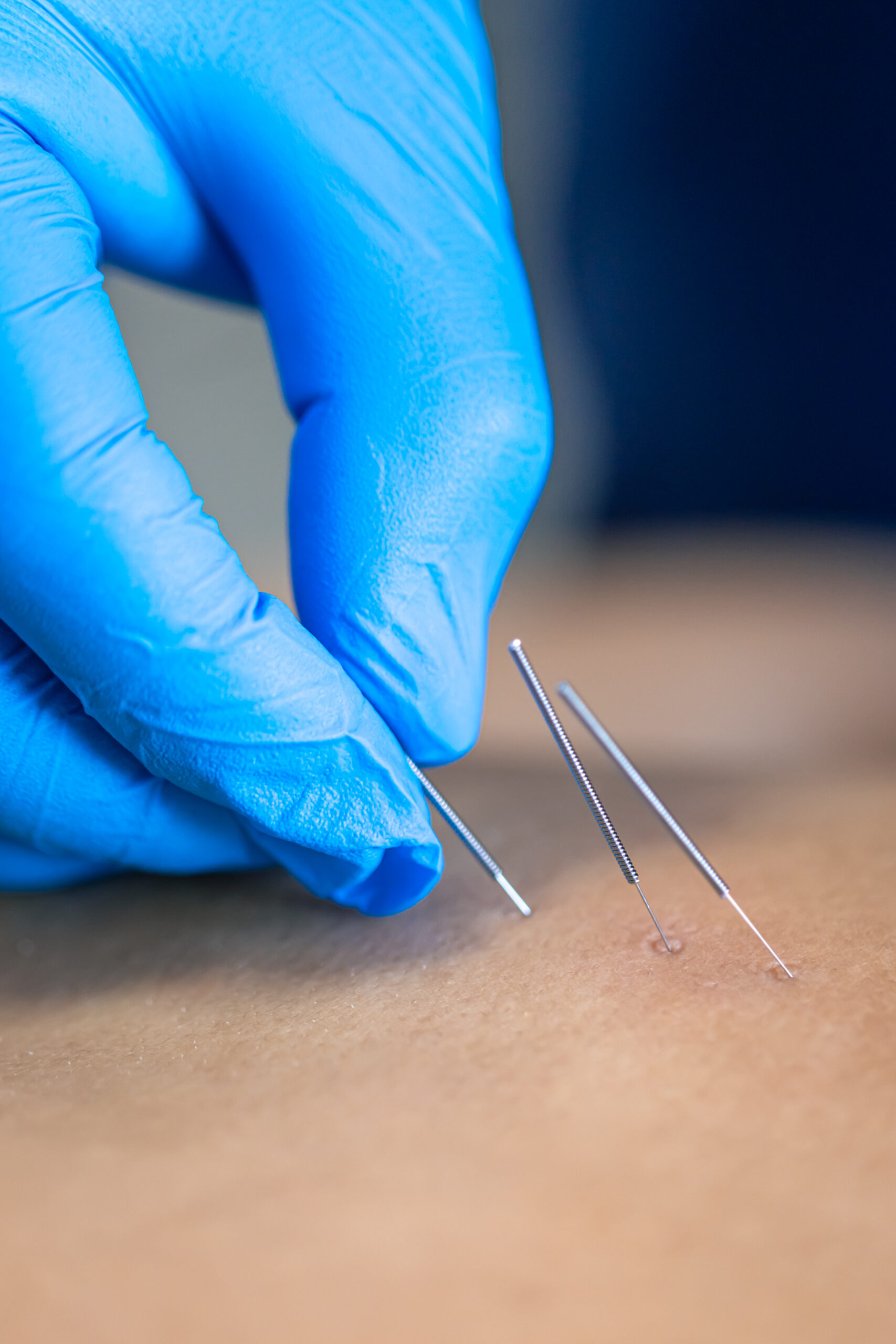 Medical Acupuncture | Dry Needling | Younger Chiropractic